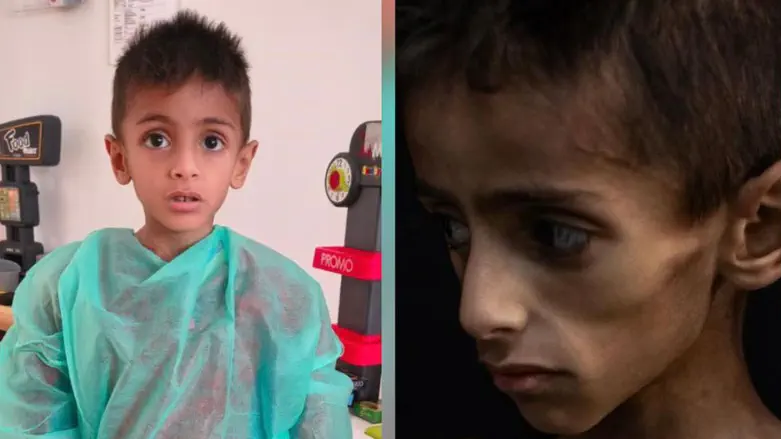 'Starved' Gaza child suffers from genetic illness and is in Italy ...